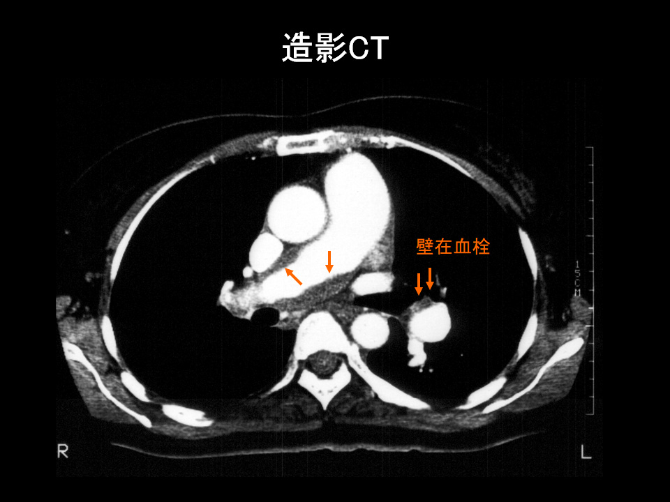 慢性血栓塞栓性肺高血圧症（CTEPH）の外科治療 | 循環器病治療の最新情報2016 | 公益財団法人 日本心臓財団