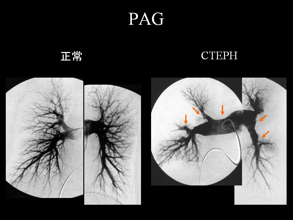 慢性血栓塞栓性肺高血圧症（CTEPH）の外科治療 | 循環器病治療の最新情報2016 | 公益財団法人 日本心臓財団